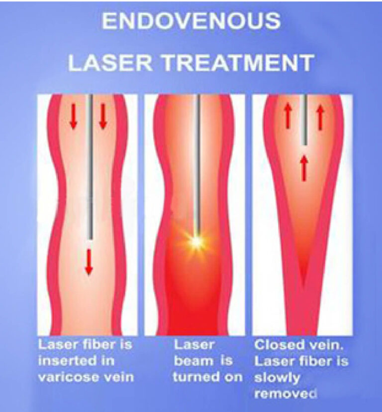 What Is Laser Ablation and How Long Does It Last?